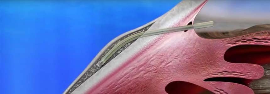Innovative Glaukom Therapie - XEN-Stent | Medical Eye-Care