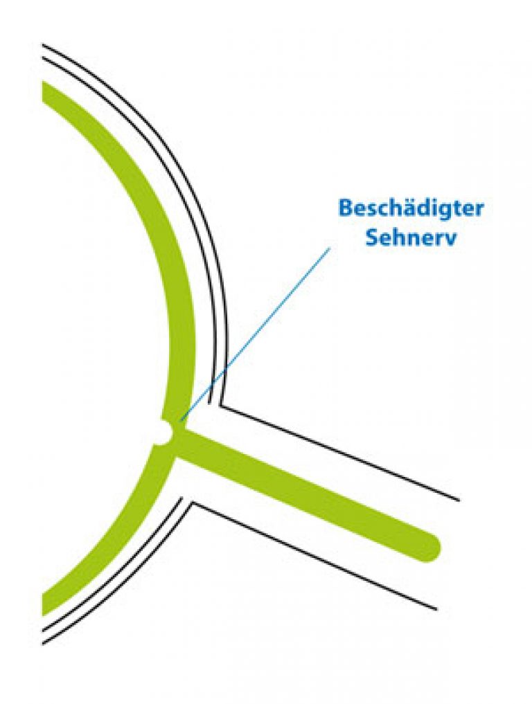 HRT – Heidelberg Retina Tomograph - Medical Eye-Care